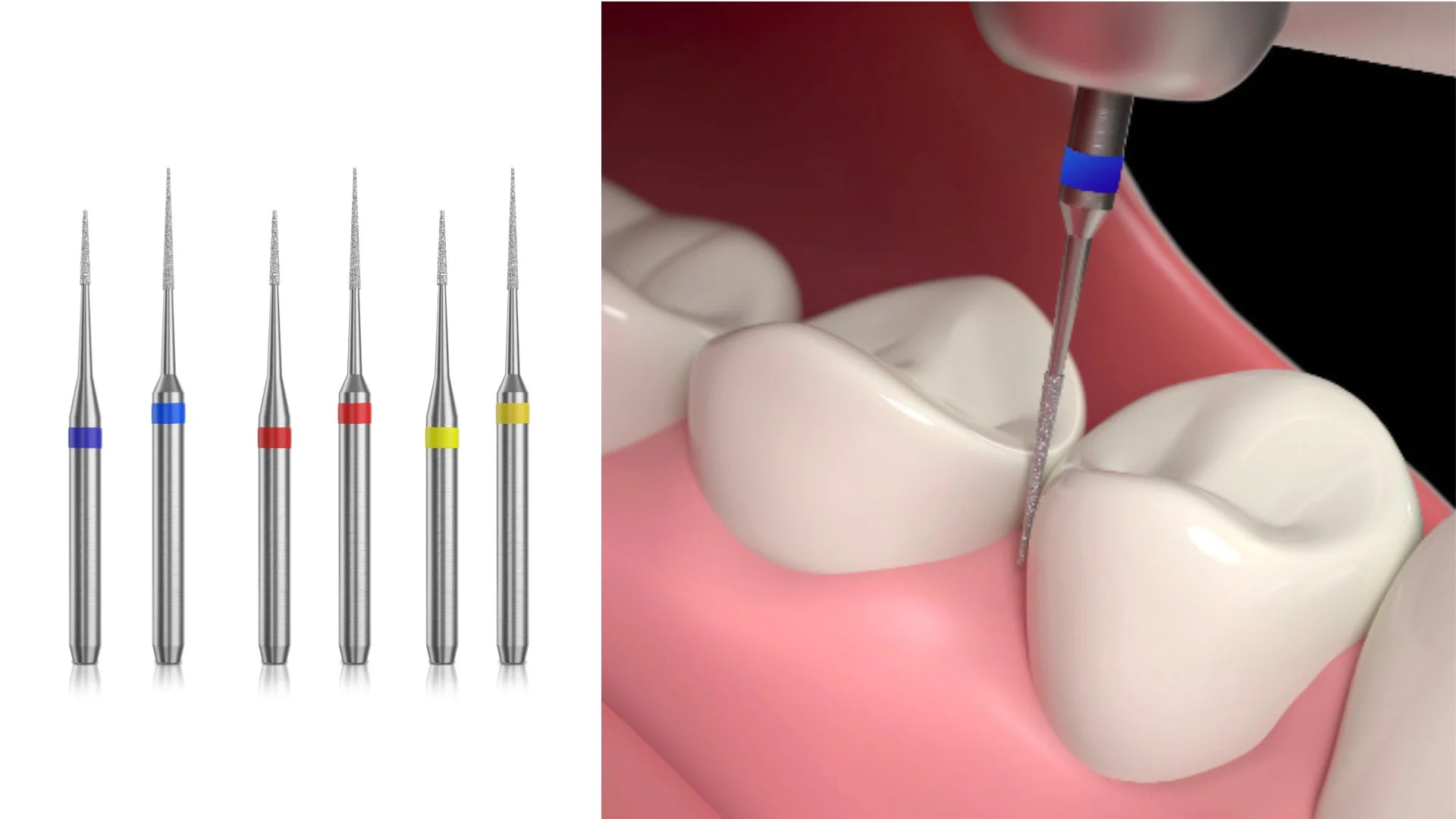 Ipr Diamond Burs 1122corp