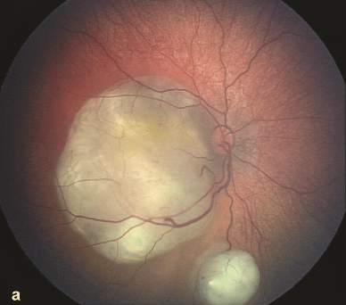 Peds Ophtho Case 1: Ophtho Visit