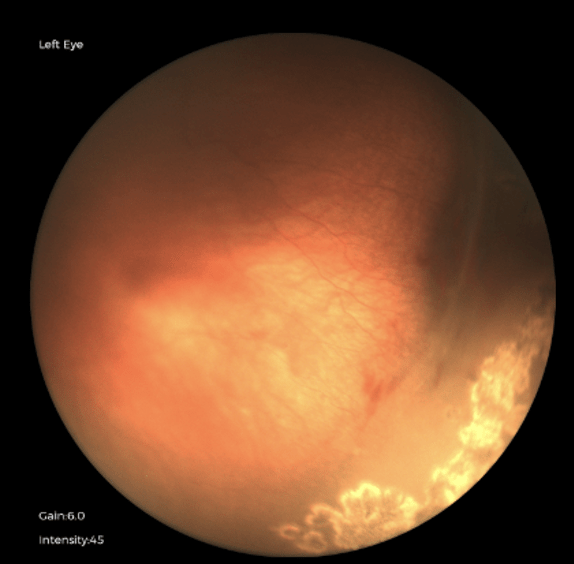 Peds Ophtho Case 4: Case continued…