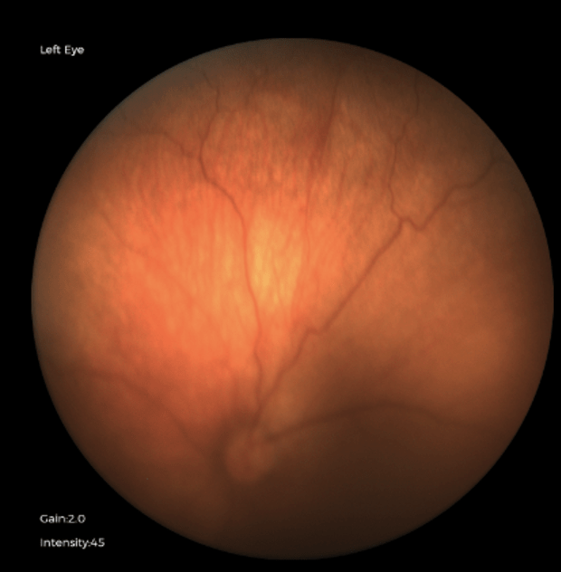 Peds Ophtho Case 4: Case continued…