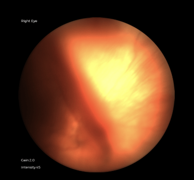 Peds Ophtho Case 4: Case continued…