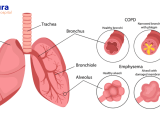 Understanding Copd Symptoms Diagnosis Management