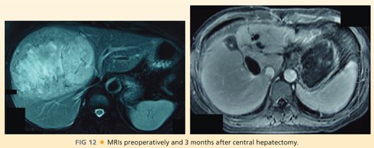 Central Hepatectomy | Abdominal Key
