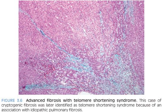 The Almost Normal Liver Biopsy | Abdominal Key