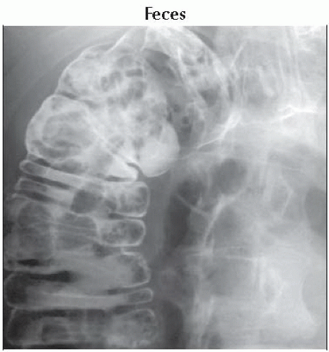 DA7-DB1-Multiple_Colonic_Filling_Defects-FFU1.gif | Abdominal Key