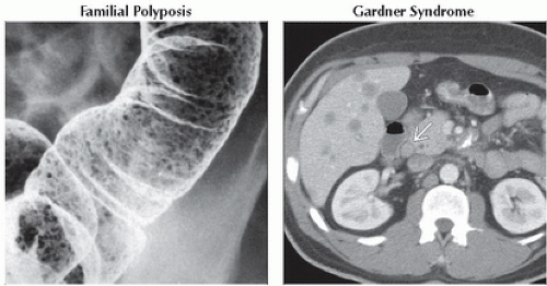 DA7-DB1-Multiple_Colonic_Filling_Defects-FFU4.gif | Abdominal Key