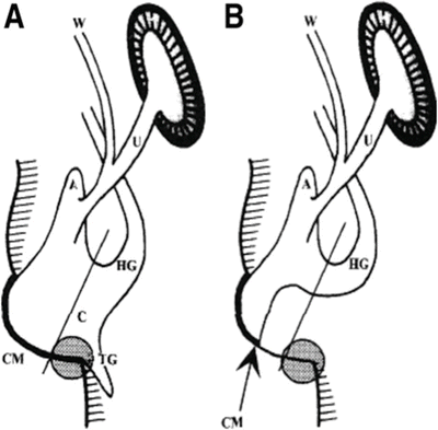 Anorectal Malformations | Abdominal Key