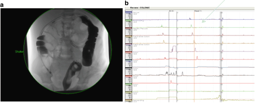 Motility After Small Bowel and Colonic Surgery | Abdominal Key