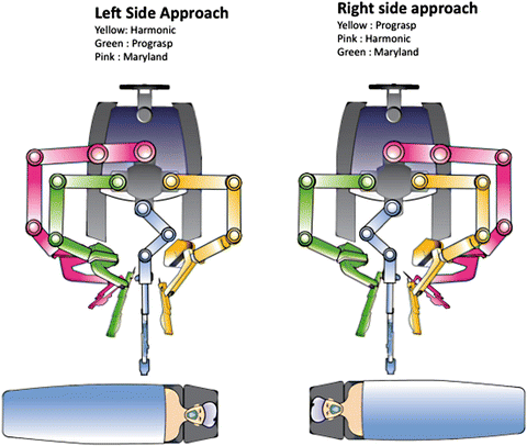 Robotic-Assisted Transaxillary Thyroid and Parathyroid Surgery ...