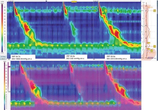 Utility of Ambulatory Esophageal pH and High-Resolution Manometry in ...