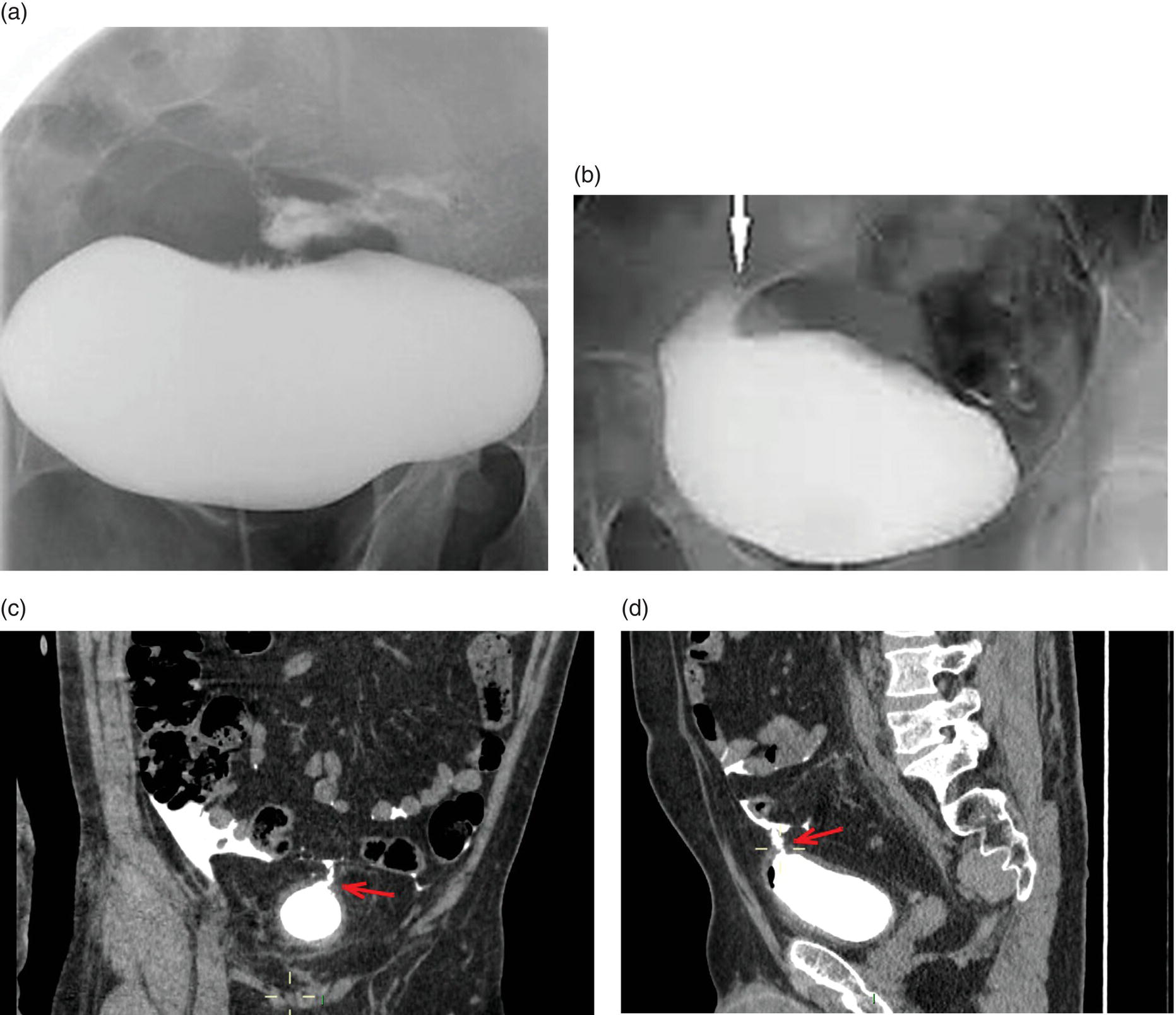 Bladder Trauma | Abdominal Key