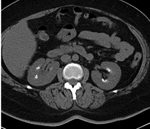 Calcium, Phosphorus, Magnesium, Stones | Abdominal Key