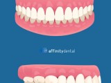 This Illustration From Affinity Dental Clinics Shows An Open Bite A