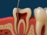 Root Canal Treatment Philippines Saving Teeth