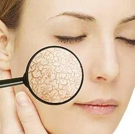 5 Ways to Get Rid of Dry Flaky Skin on Face - Remove Facial Dryness