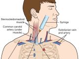 Internal Jugular Vein Central Venous Access Anesthesia Key
