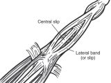 Digit Dislocation And Reduction Anesthesia Key