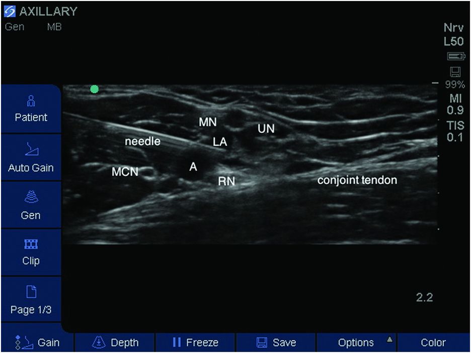 Ultrasound-guided axillary brachial plexus block | Anesthesia Key