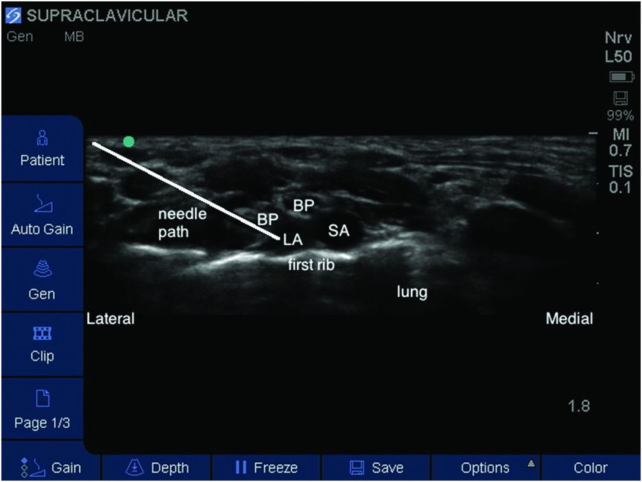 Ultrasound-guided supraclavicular brachial plexus block | Anesthesia Key