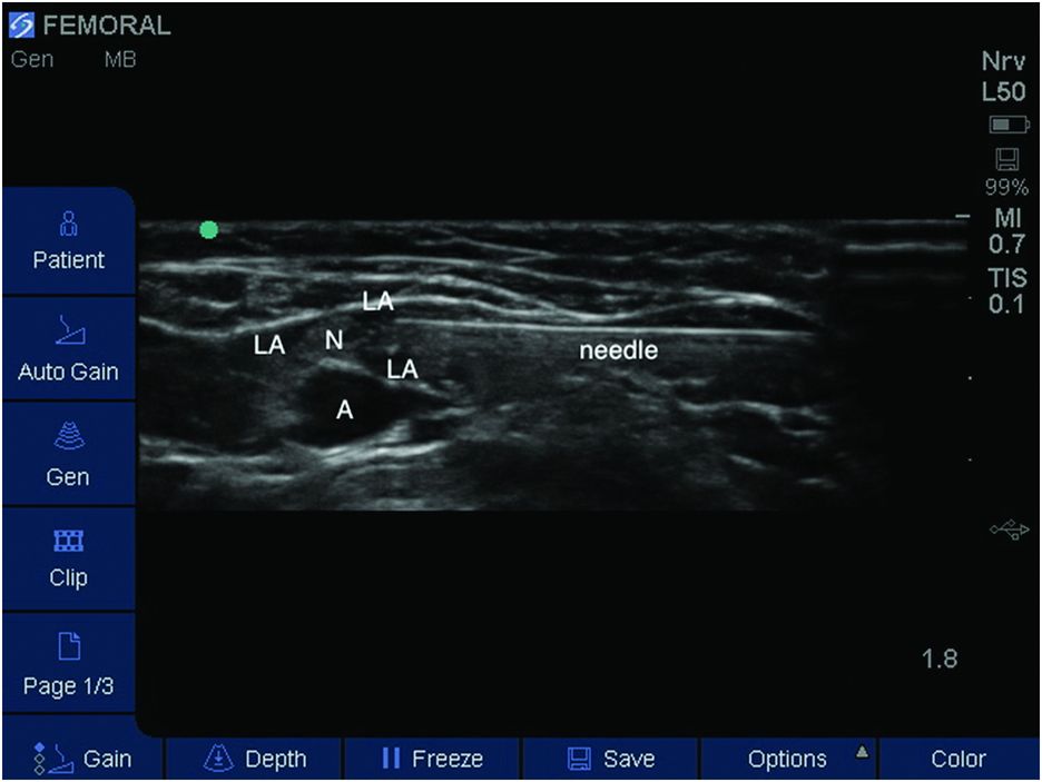 Ultrasound-guided femoral nerve block | Anesthesia Key