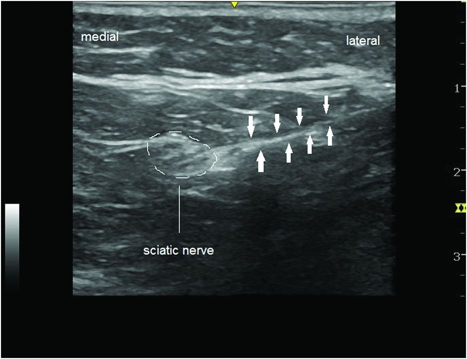 Ultrasound-guided sciatic nerve block | Anesthesia Key