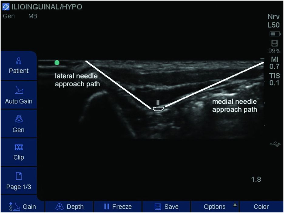 Ultrasound-guided ilioinguinal/iliohypogastric block | Anesthesia Key