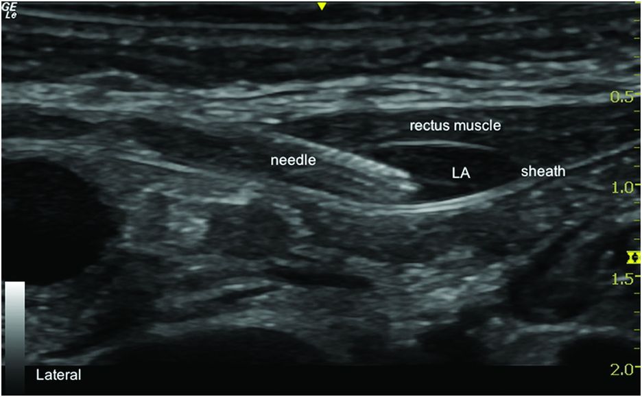 Ultrasound-guided rectus sheath block | Anesthesia Key