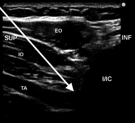 General anaesthesia for caesarean section and transverse abdominal ...