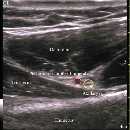 Rotator cuff repair | Anesthesia Key