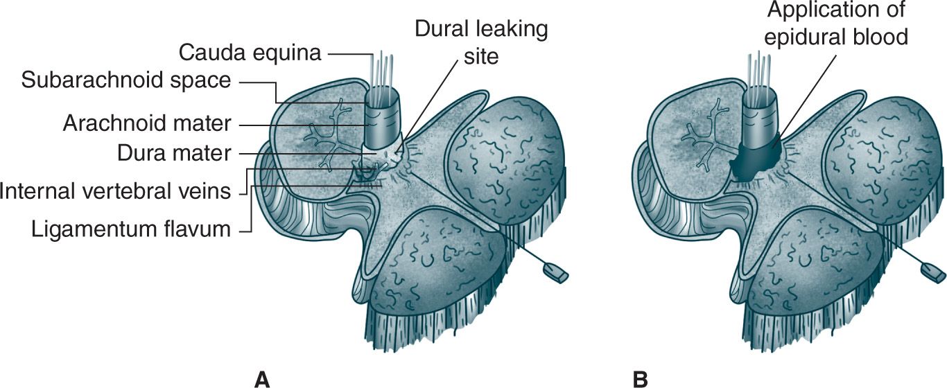 Postdural Puncture Headache | Anesthesia Key