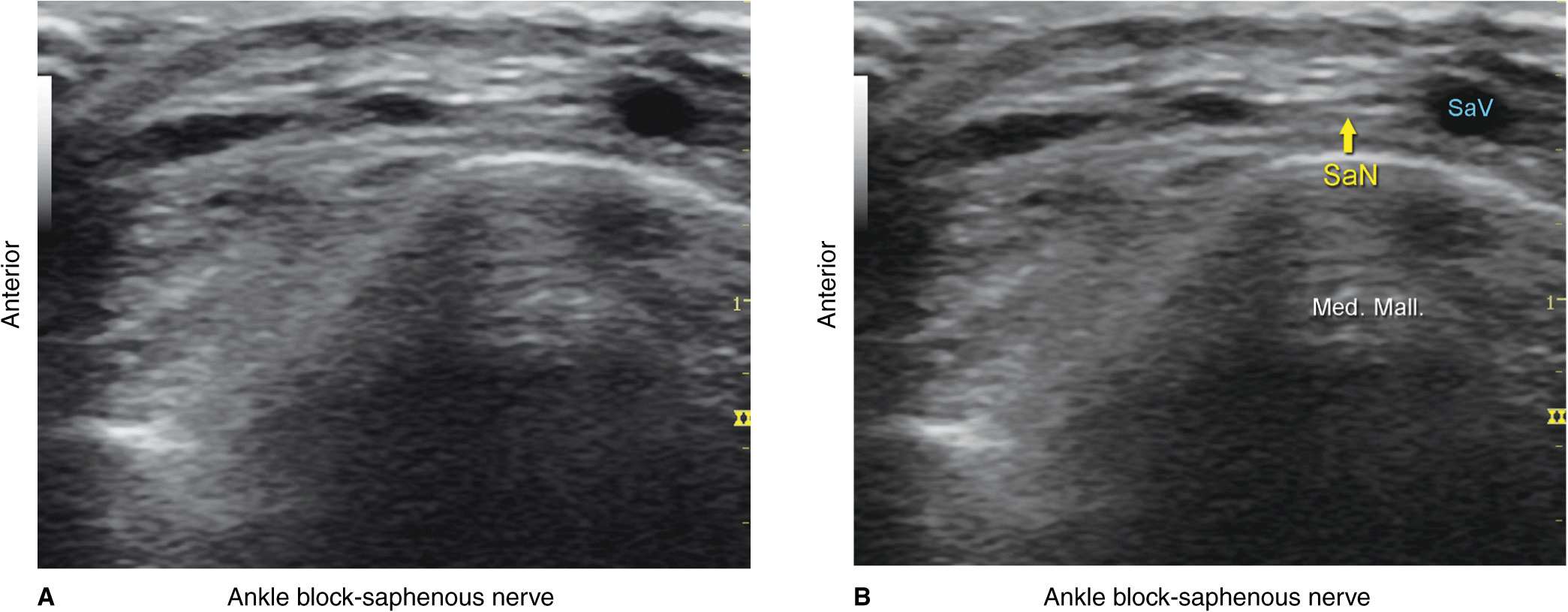 Ultrasound-Guided Ankle Block | Anesthesia Key