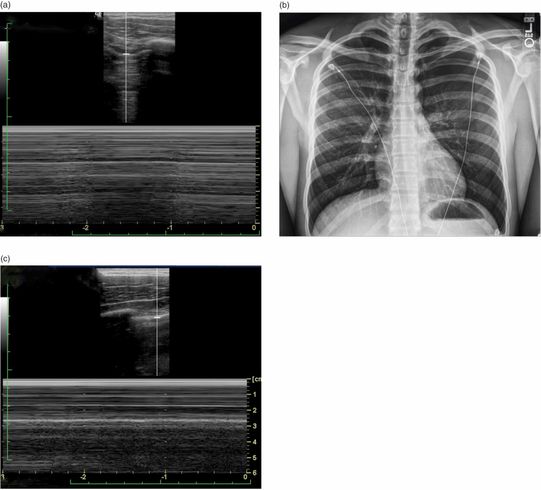 Pulmonary Ultrasound Anesthesia Key