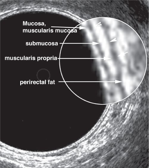 Anorectal Abscess | Anesthesia Key