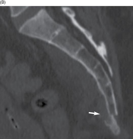 Fractures and dislocations of the thoracolumbosacral spine | Anesthesia Key
