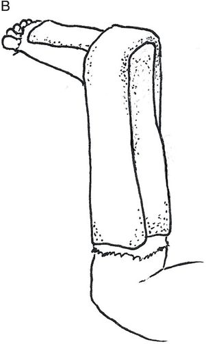 Basic Principles of Splinting in the Emergency Department | Anesthesia Key