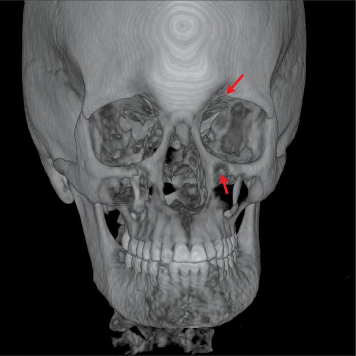 Periorbital Nerve Blocks Supraorbital Supratrochlear And