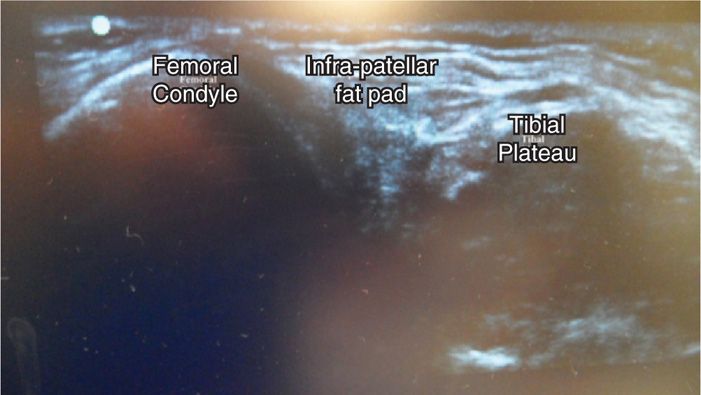 Intra-Articular Joint Injections | Anesthesia Key