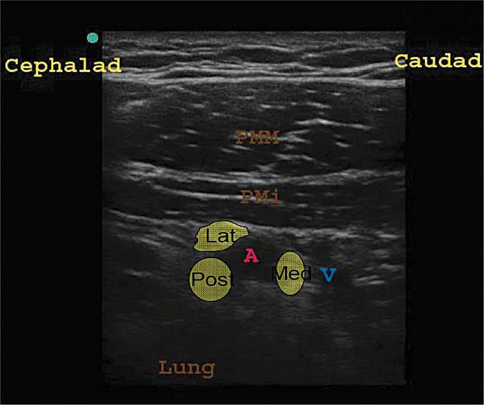 Cervical Nerve Root Blocks | Anesthesia Key