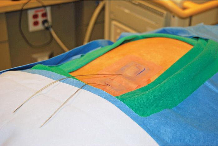 Anterograde Versus Retrograde Lead Placement | Anesthesia Key