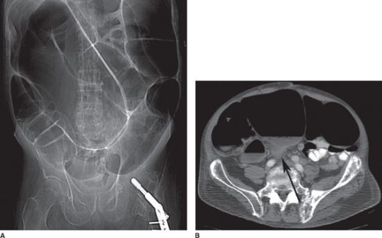 Intestinal Obstruction and Dysmotility Syndromes | Anesthesia Key