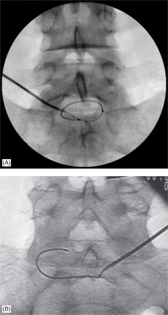 Intradiscal Electrothermal Therapy | Anesthesia Key