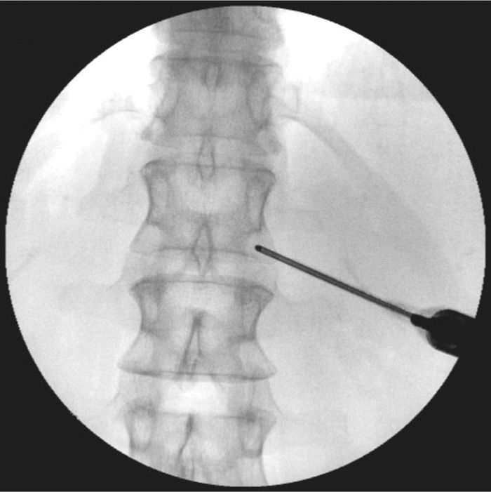 Genitofemoral Nerve Block | Anesthesia Key