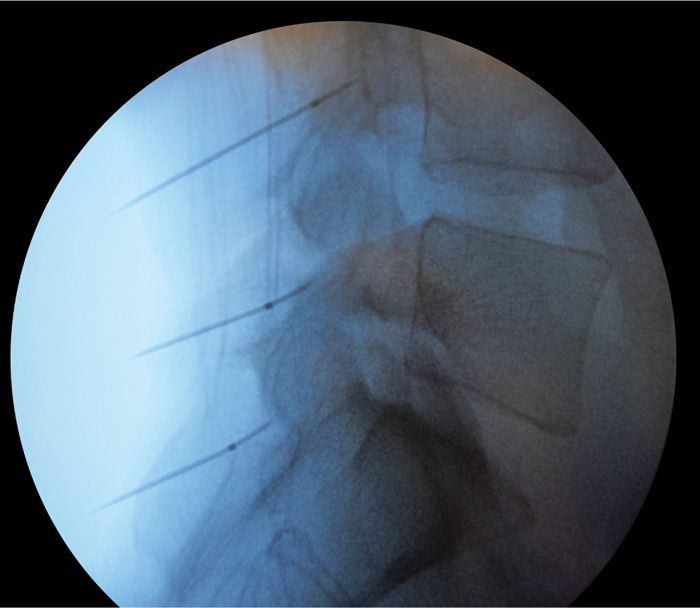 Radiofrequency Neurolysis | Anesthesia Key