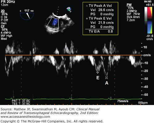 Evaluation of Right Heart Function | Anesthesia Key