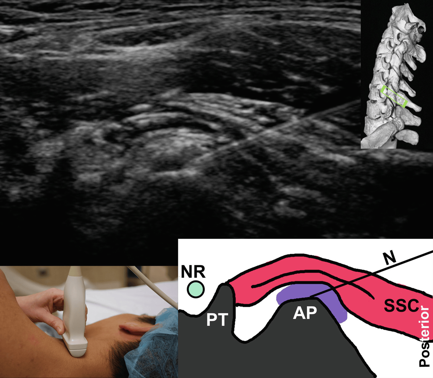 Medial Branch And Third Occipital Nerve Blocks Anesthesia Key