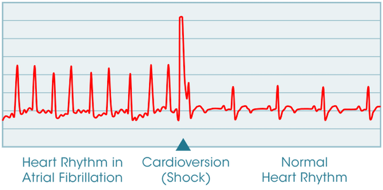 Being cardioverted | Arnold Zwicky's Blog