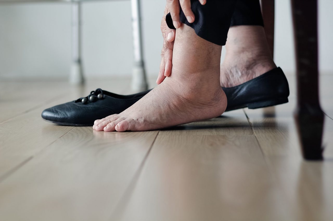Swelling Ankles Feet Heart Failure swelling-ankles-feet-heart-failure