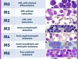 Aml Types Classification And Identification Kolh