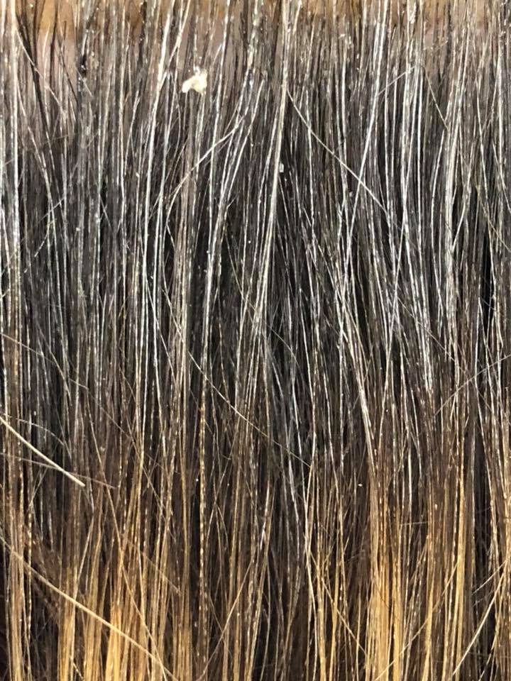 Trichology- Monilethrix - AskMags.com