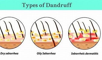 Dandruff- Many Types of Dandruff - AskMags.com